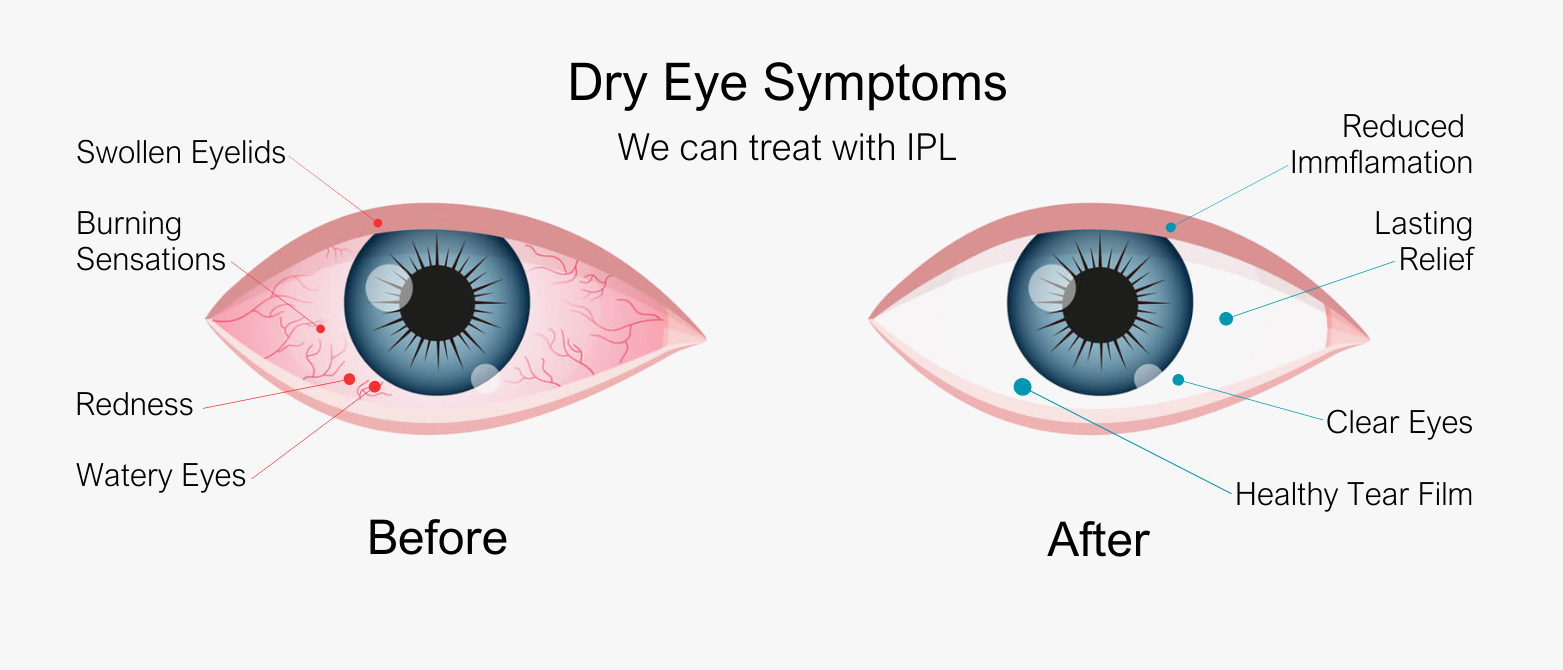 Dry Eye Treatment- Dryness Disease Causes & Symptoms- Philip Milford ...
